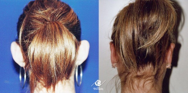 Fotos antes y despúes de operacón cirugía de orejas – Otoplastia ...