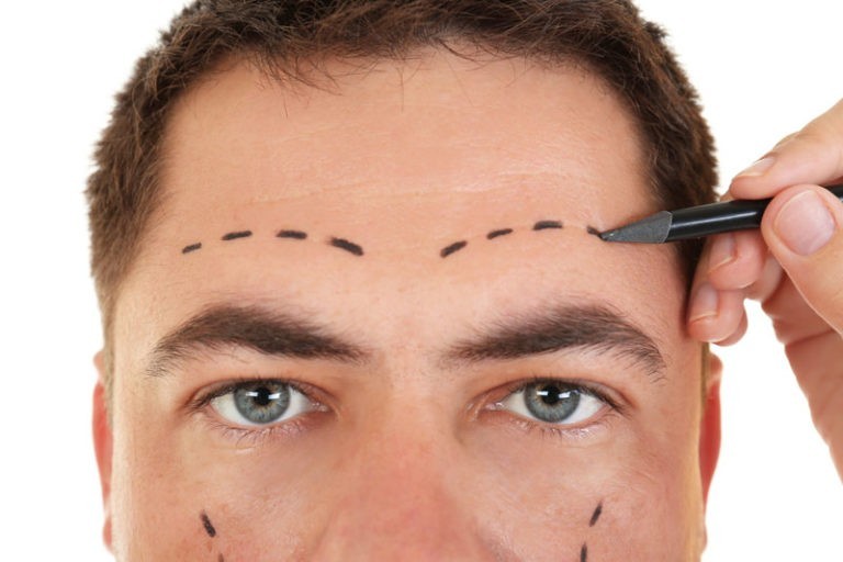 Lifting de Cejas Endoscópico - Cirugía Estética, Medicina Estética y ...
